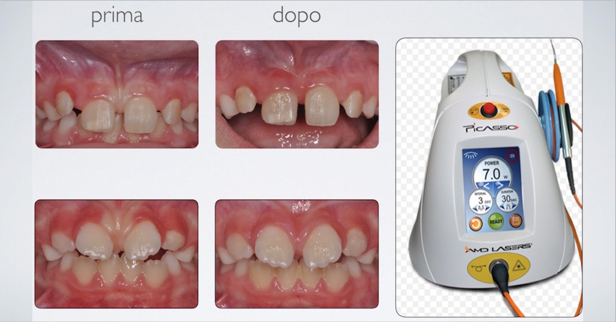 Trattamenti ortodontici bambini - Dott. Nicola Preda